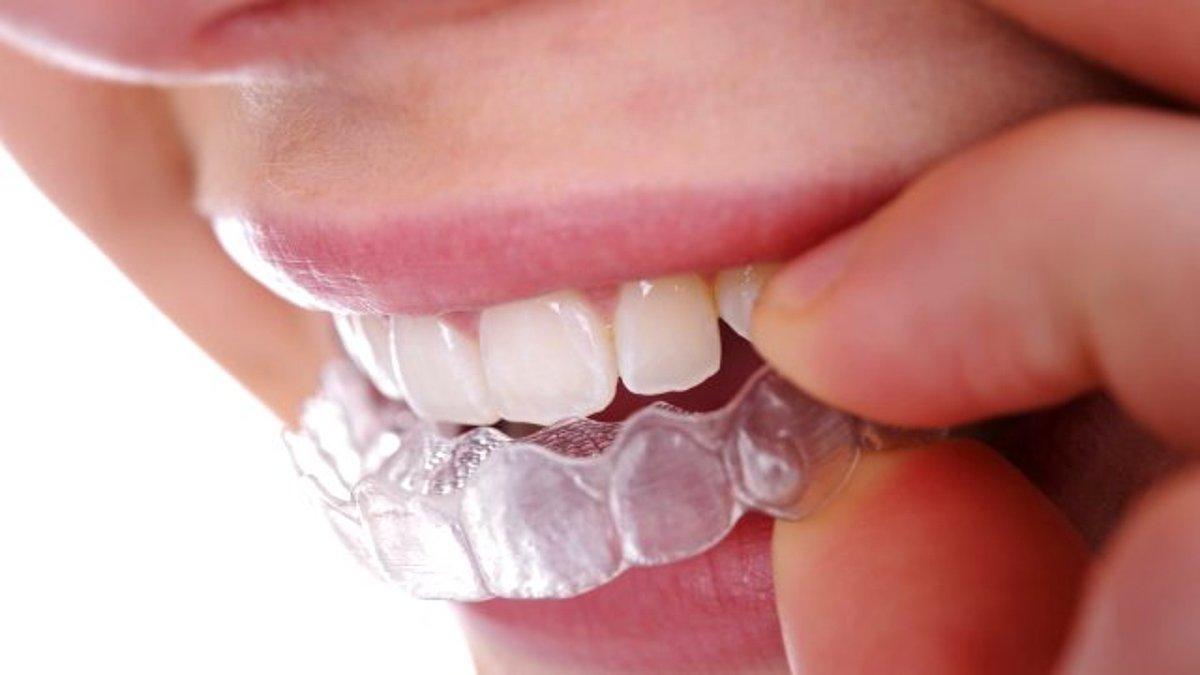 Şeffaf Plak Tedavisi - Çorum İnvisalignÇorum İnvisalign